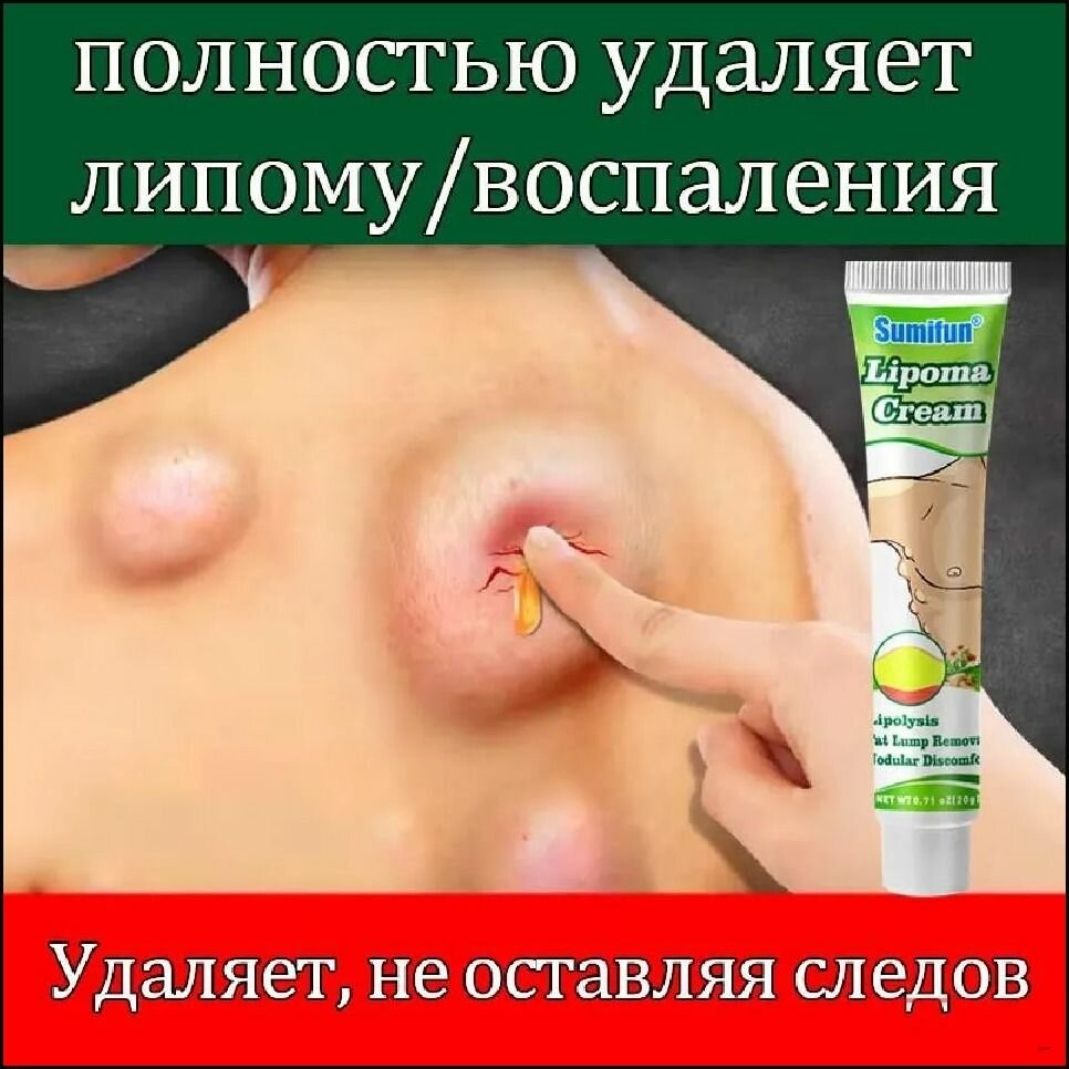 Липома удаляет крем, для устранения жировых отложений и подкожных шишек, показан при отечности кожи, фиброзном жировике, 20 г N