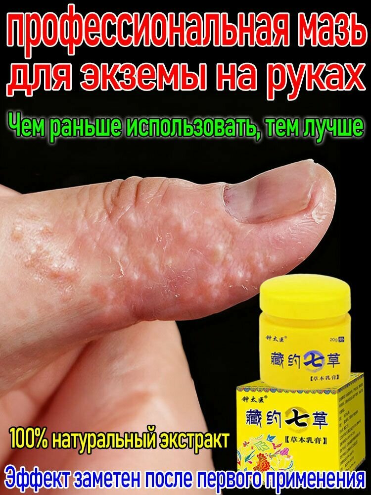 Мазь от экземы на руках