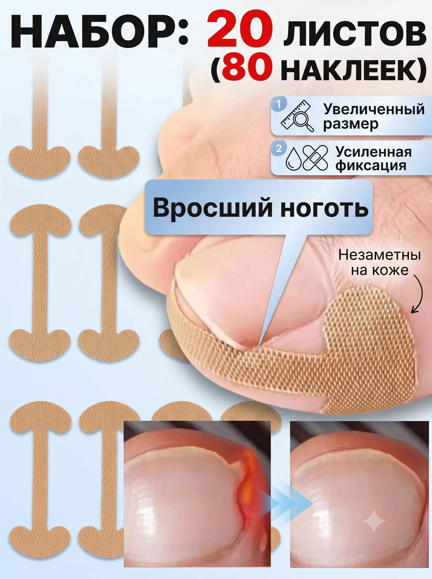 Наклейка пластырь, корректор от вросшего ногтя против врастания ногтевой пластины,20 листов (80 наклеек)