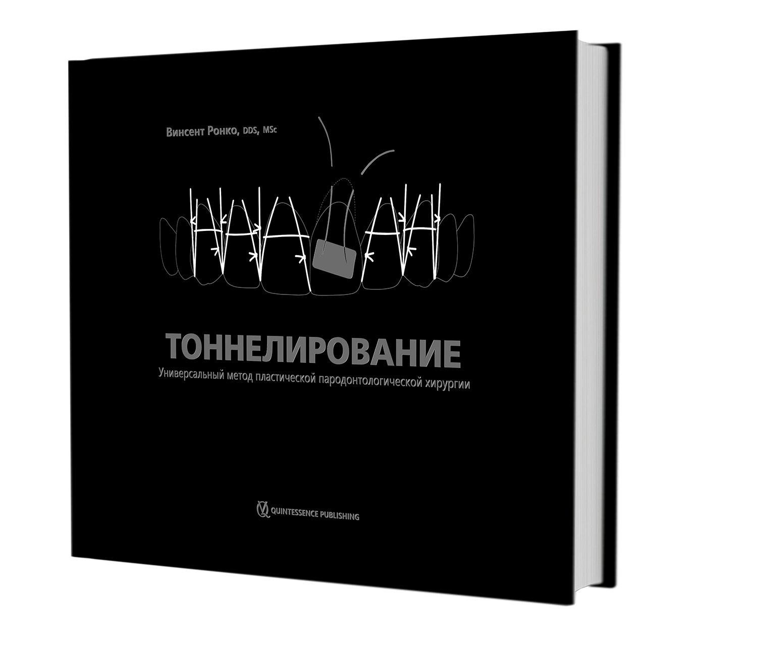 Тоннелирование. Универсальный метод пластической пародонтологической хирургии