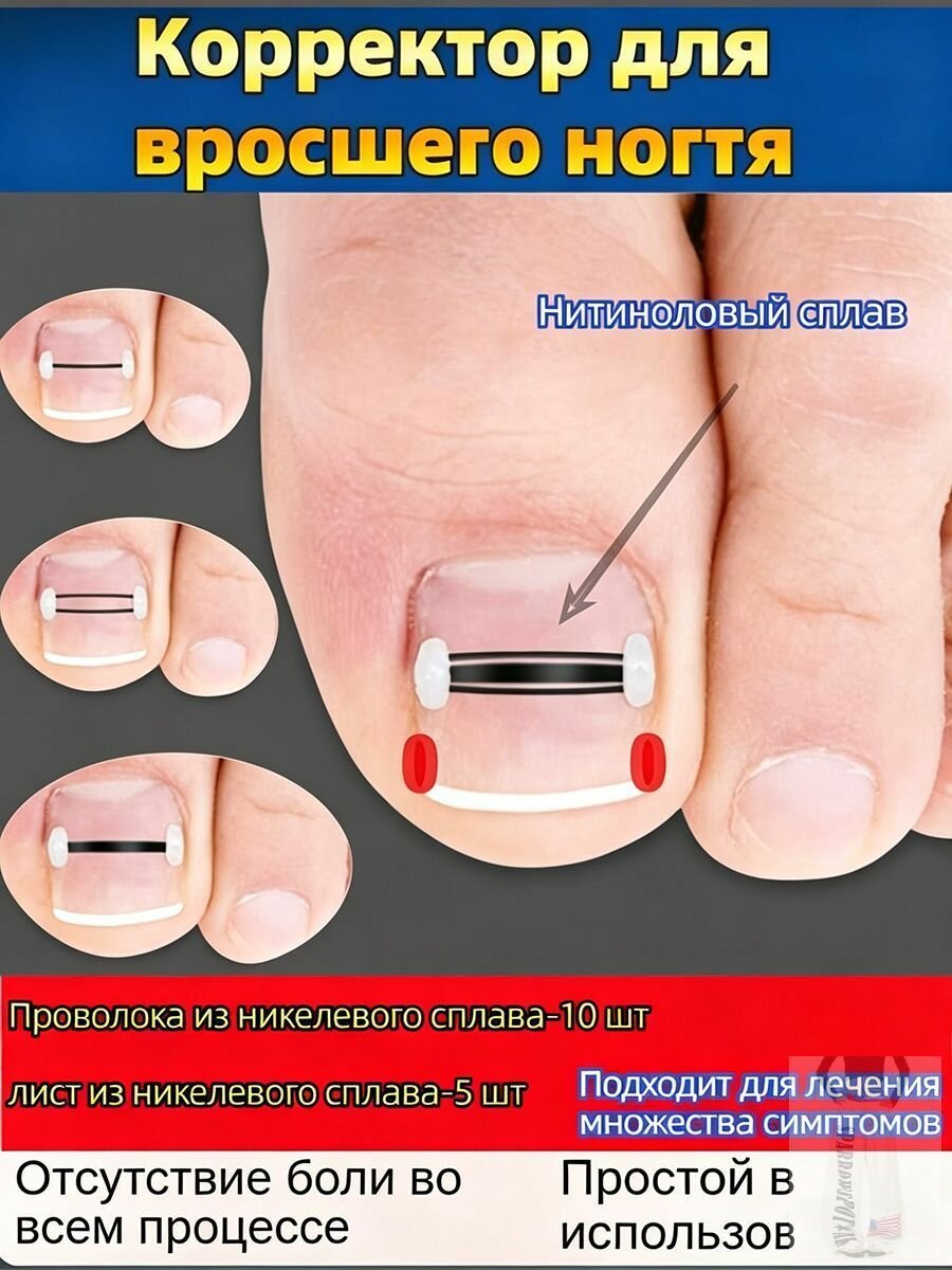 Комплект из 10+5 никелид-титановых корректоров для вросших ногтей