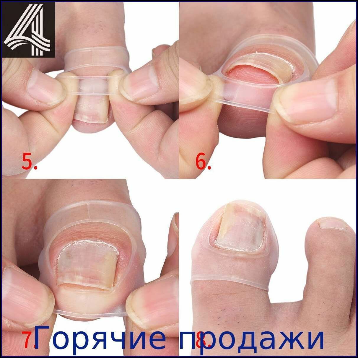 Эксклюзивный силиконовый корректор для вросших ногтей, защитный чехолнапальчник