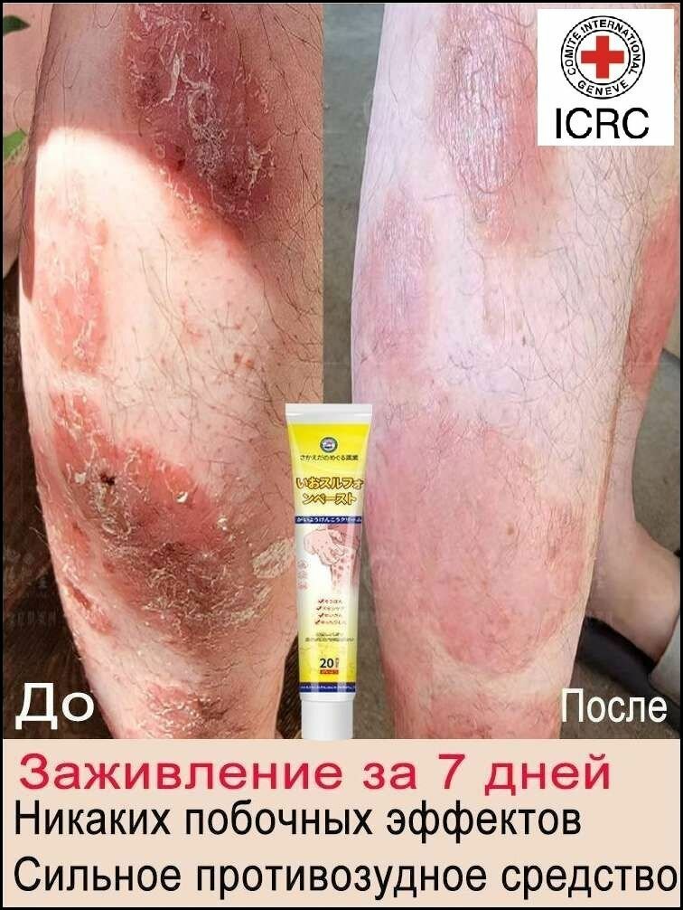 Противозудный и антибактериальный крем для тела, эффективный при экземе, псориазе и герпесе