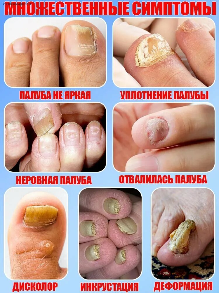 Спрей для лечения грибка ногтей, руках, для лечения грибка и онихолизиса, противогрибковое для роста и укрепление,30мл