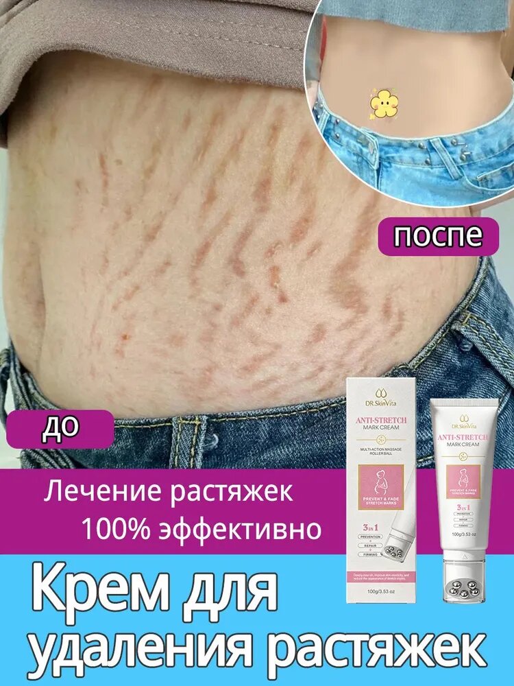 Крем от растяжек с массажным роликом, 100 г: предотвращает и осветляет растяжки, увлажняет кожу, способствует заживлению рубцов