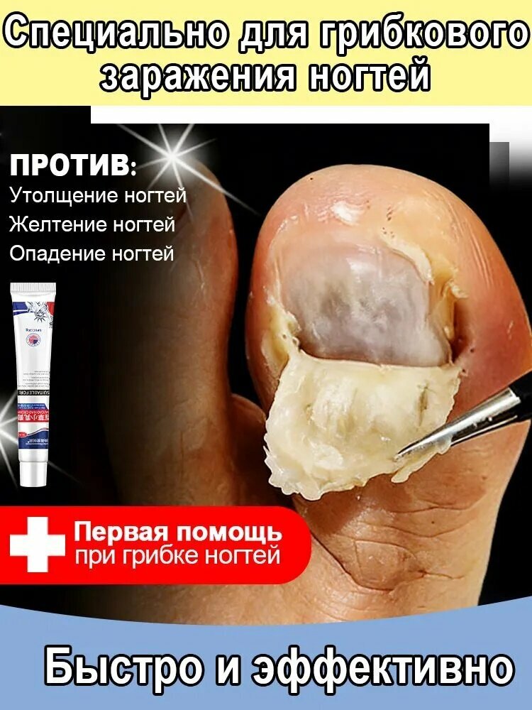 Мазь от грибка ногтей и стопы ног противогрибковая. Крем гель от грибка ногтей / 20 мл