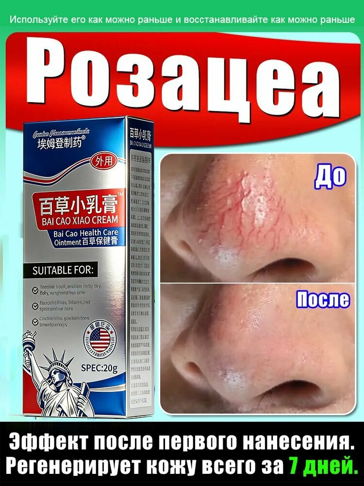 Мазь от розацеа для лица, интенсивное лечение покраснений и сосудистых звездочек, снимает воспаление.20г