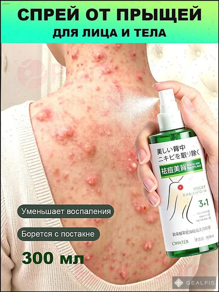 Спрей тоник для лица с азелаиновая кислота от прыщей и акне, угрей и черных точек, подходит для подростков с чувствительной кожей