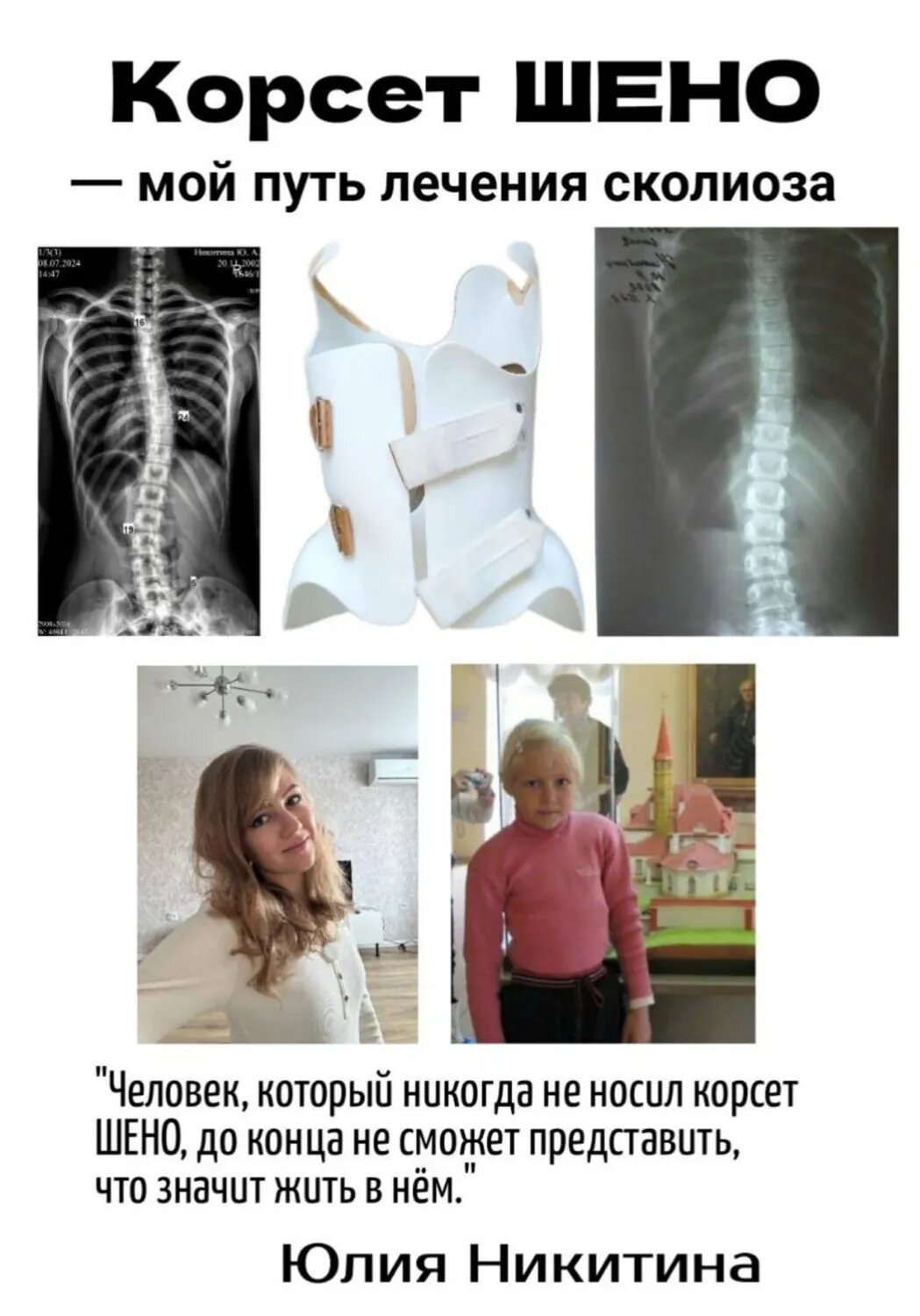 Корсет Шено. Мой путь лечения сколиоза [Цифровая книга]