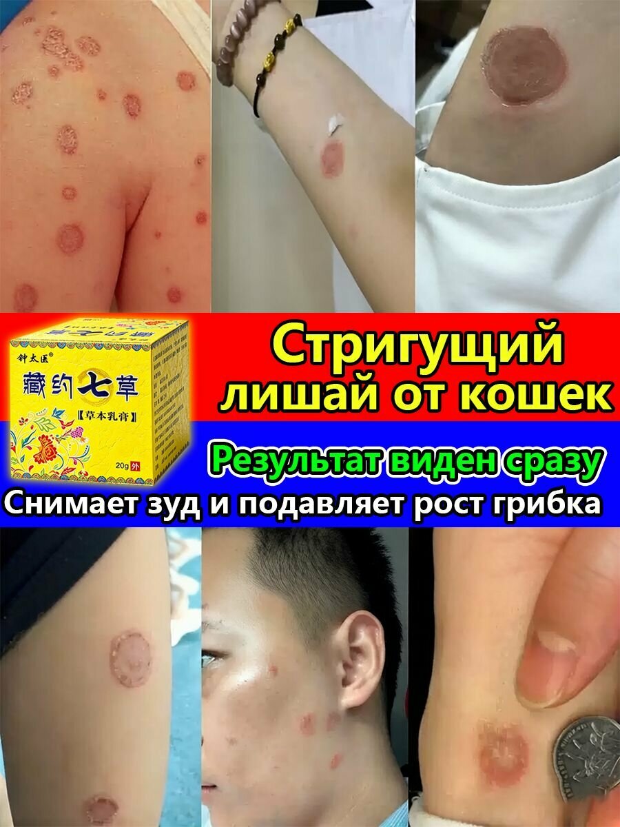 Мазь для лечения лишая, который перешёл от кошки на человека