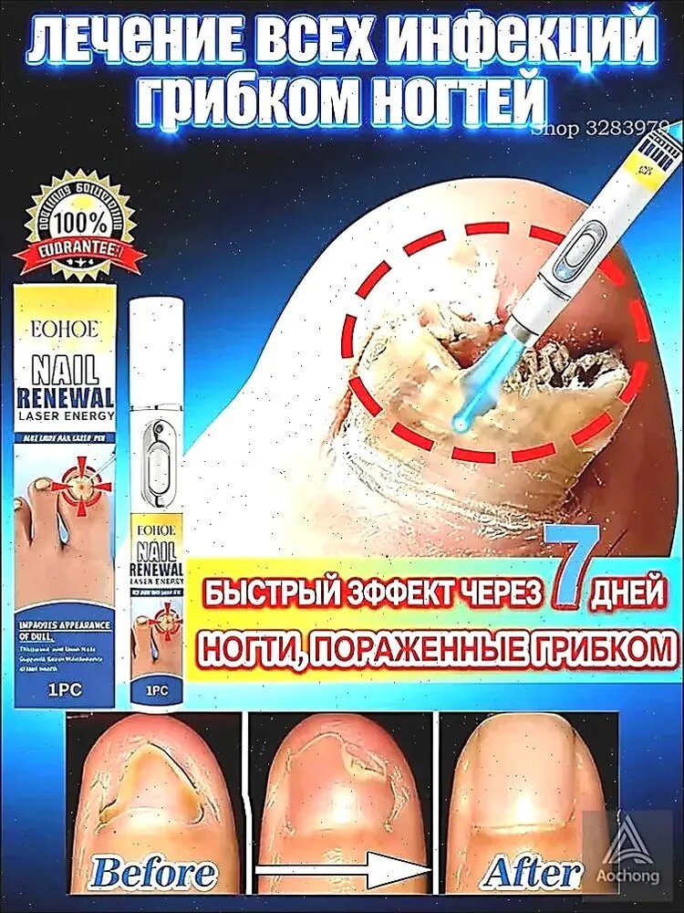 Лазерная ручка для лечения грибка ногтей, Противогрибковое , Устранение паронихии восстанавливает ногти. Попрощайтесь с онихомикозом!