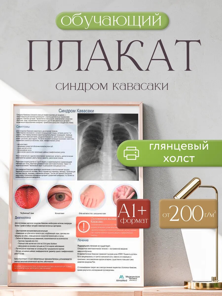 Синдром Кавасаки медицинский плакат А1+, глянцевый холст от 200г/м2