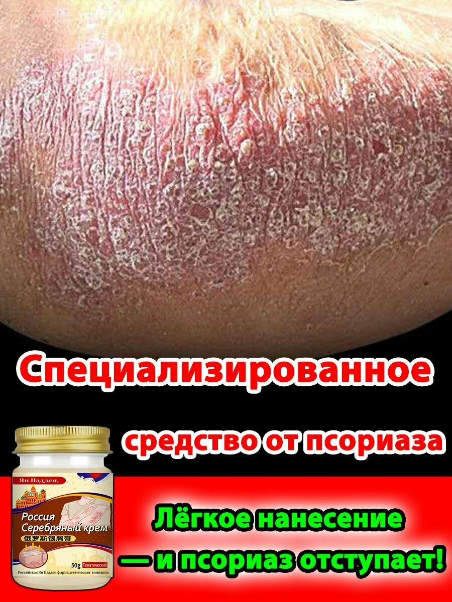 Мазь от псориаза китайская Антипсориаз крем негормональный от дерматита и экземы снимает зуд покраснение и раздражение 50 г