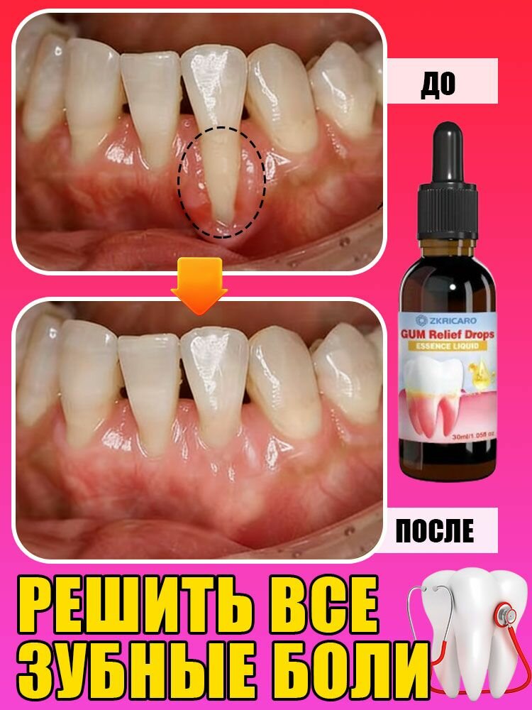 Масло для десен при воспалениях в полости, укрепления дёсен и снижения кровоточивости, Быстро лечит опухшие, лечение пародонтита и гингивита, Чистое дыхание, комплексный уход + защита дёсен,30мл