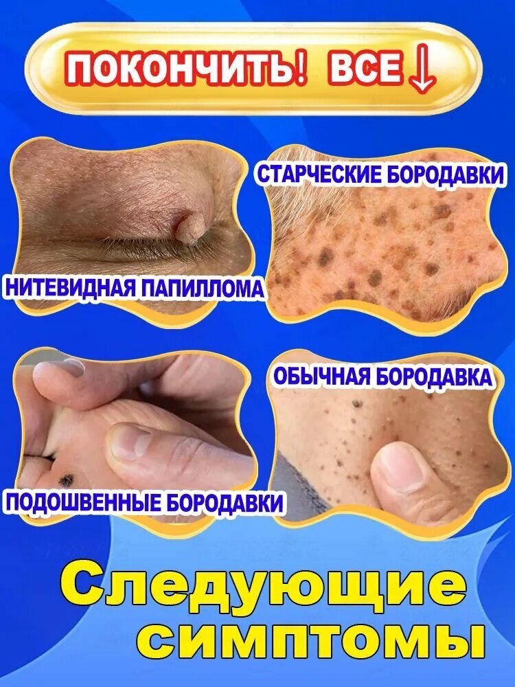 Лазерная указка для удаления бородавок. Удаляйте бородавки, родинки, папилломы и остроконечные кондиломы с тела и лица. Это безопасно, безболезненно и не имеет побочных эффектов. Лазерная указка.