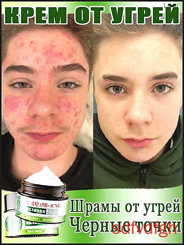 Салициловая мазь от прыщей, эффективно борется с воспалениями, направленная на акне и угри, прыщами и последствиями акне, подходит подросткам и проблемной коже, 30 г.