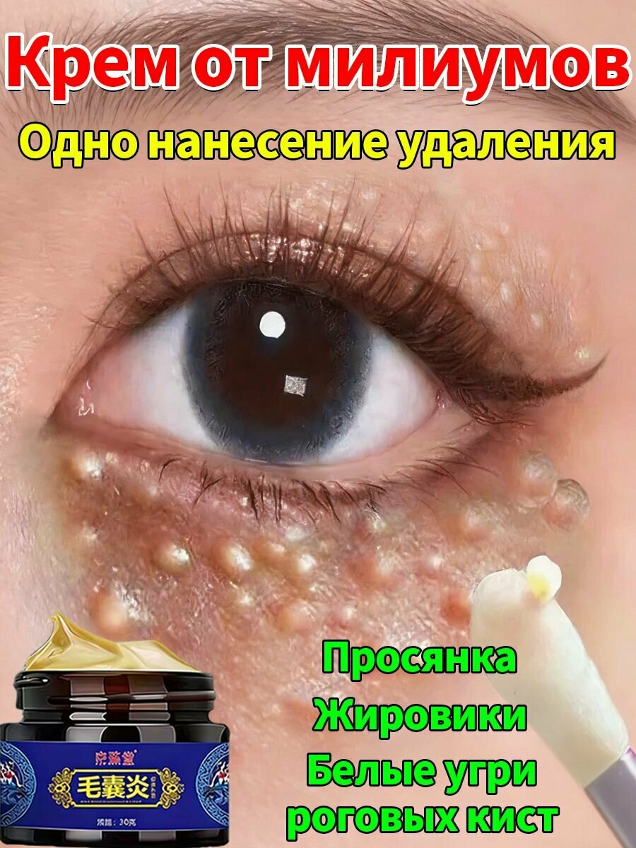 Крем от милиумов, от просянки, белых угрей и роговых кист для кожи