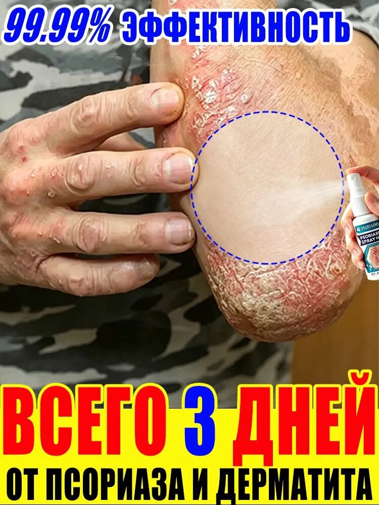 Cпрей от псориаза Быстрое облегчение зуда, Для экземы, невропатического дерматита, грибковых заболеваний, дерматита и себореи , негормональное,30 мл
