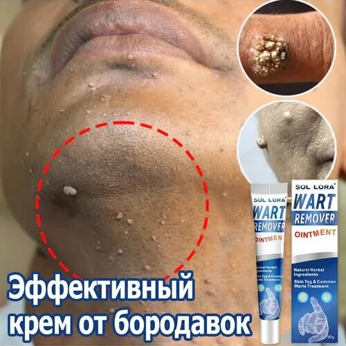 Крем-гель от бородавок, Средство от папиллом и бородавок, мазь для ухода за кожей 20 мл