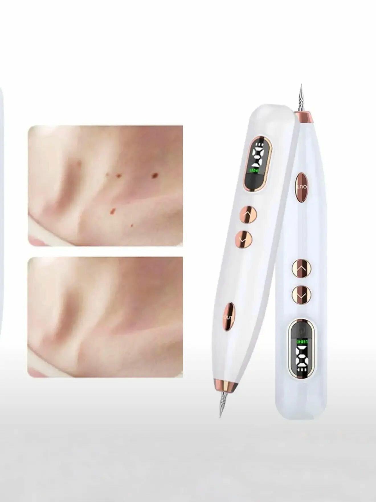 Аппарат для удаления папиллом бородавок родинок