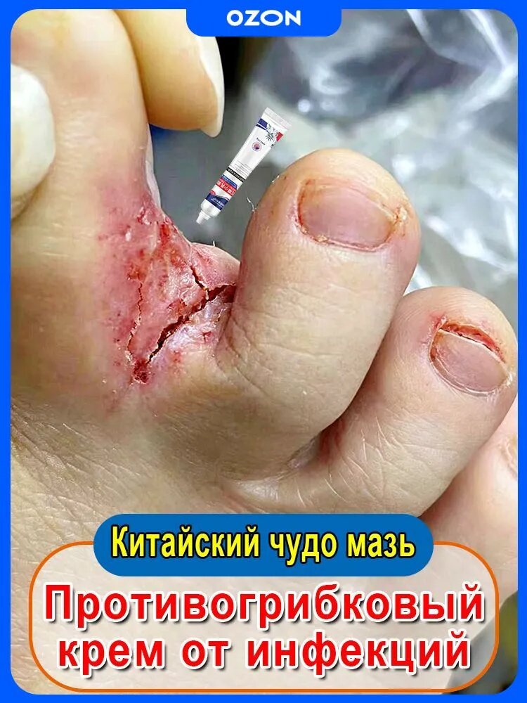 Противогрибковая мазь для стоп, лечит межпальцевой грибок, снимает воспаление и заживляет трещины, 20 г