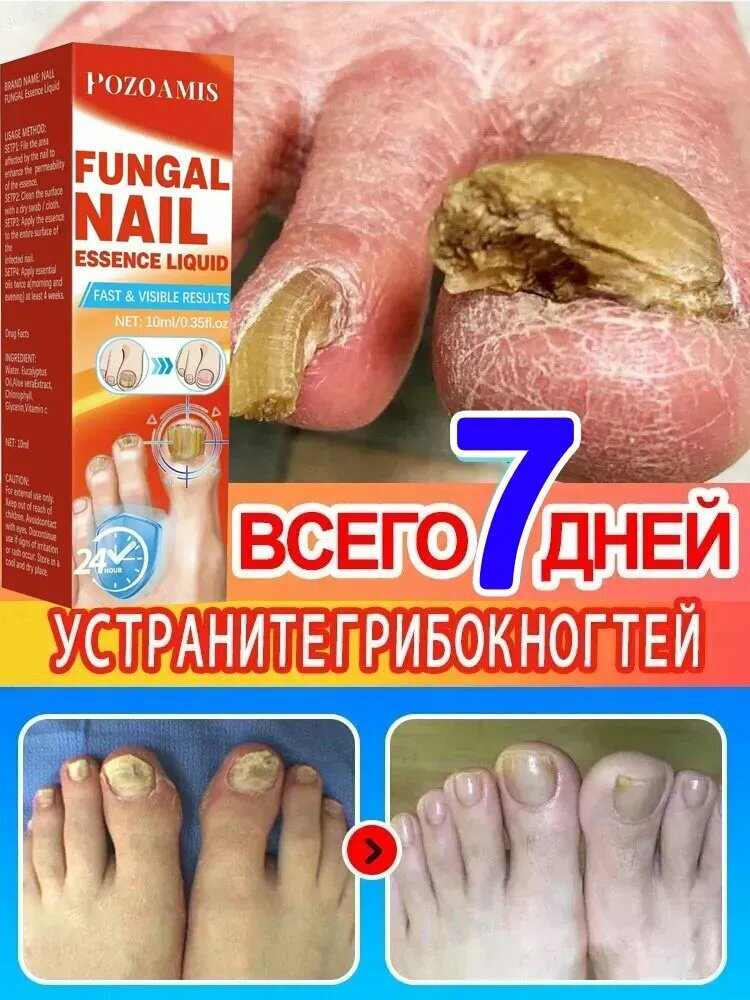 Мазь для лечения грибка ногтей: противогрибковое действие, лечение параонихии, восстановление ногтей. Устранение онихомикоза!30 мл