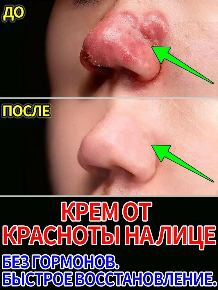 Лечебный крем от розацеа 30 граммкрасный нос и прыщи