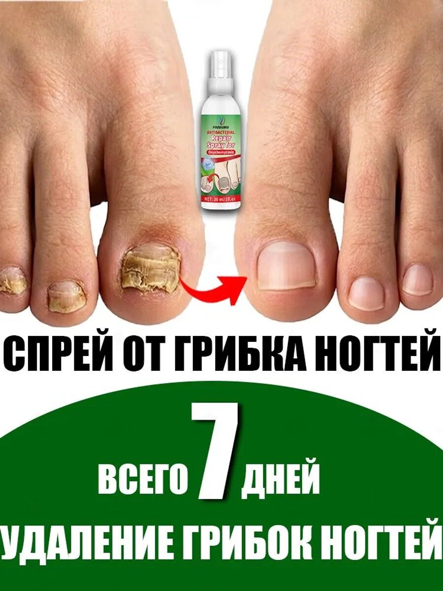 Спрей от грибка ногтей противогрибковый, эффективное удаление онихомикоза. Восстановление пластины