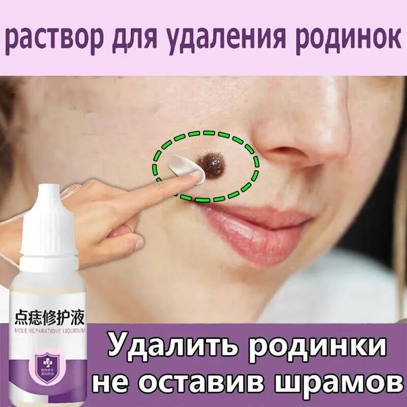 Жидкость для удаления родинок и бородавок, 10 мл, Подходит для удаления пятен и родинок Восстановите гладкость кожи