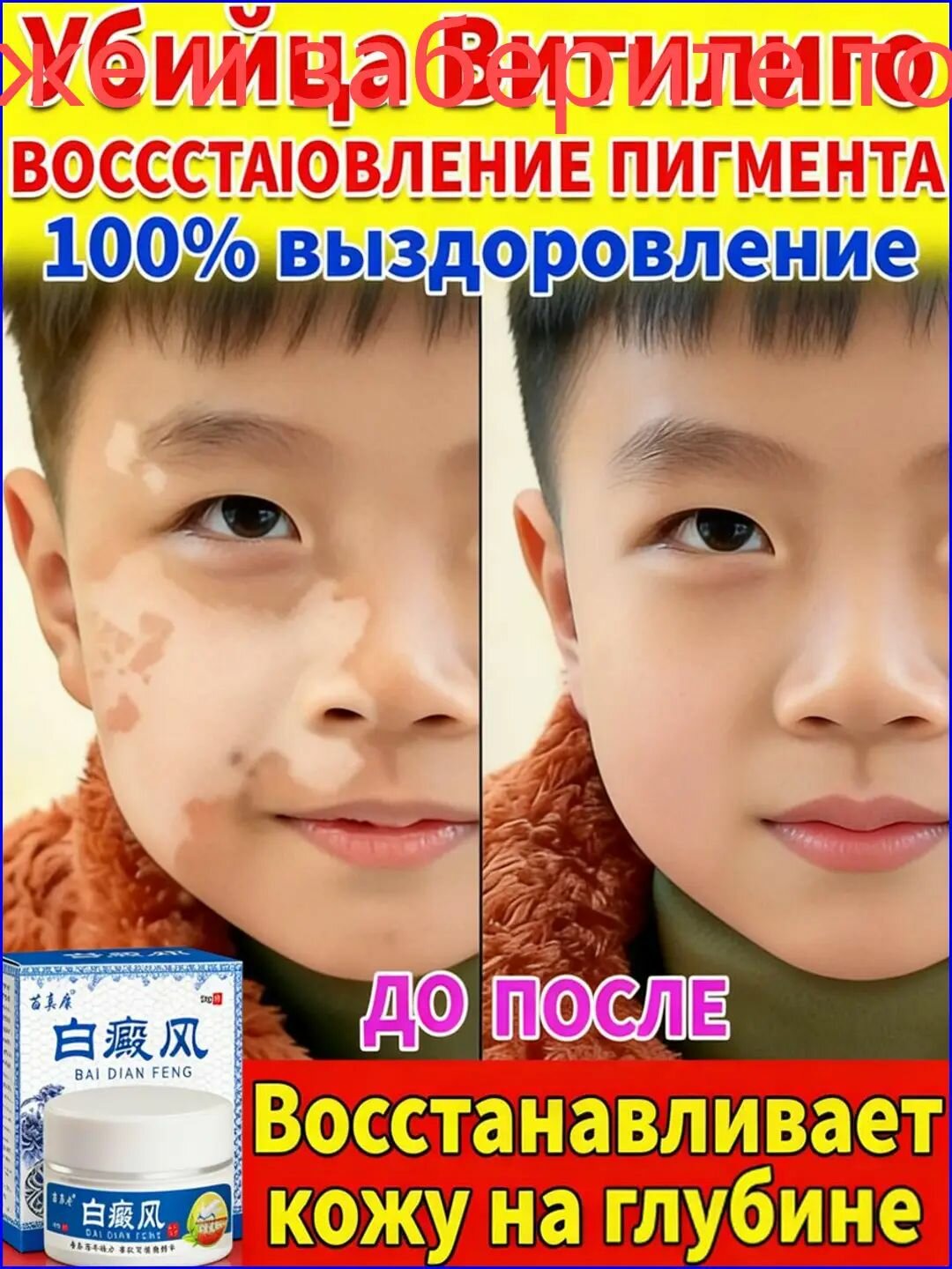 Крем от витилиго, Подходит для пациентов с витилиго, Эффективно удаляет белые пятна, устранения пигментации выравнивания тона кожи. средство для улучшения пигментации и выравнивания тона кожи,30г