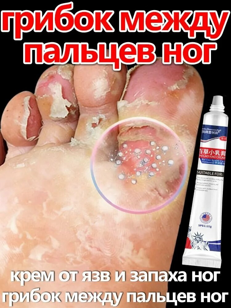 Экзикол мазь от грибка ног, мазь от грибка ног между пальцев, крем от язв и запаха ног,20 г