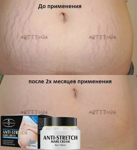 Крем от растяжек для беременных, 100 г, восстанавливает эластичность и питание кожи, подходит для использования во время беременности и после родовzMZgt