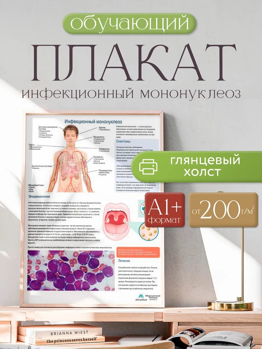 Инфекционный мононуклеоз медицинский плакат А1+, глянцевый холст от 200г/м2