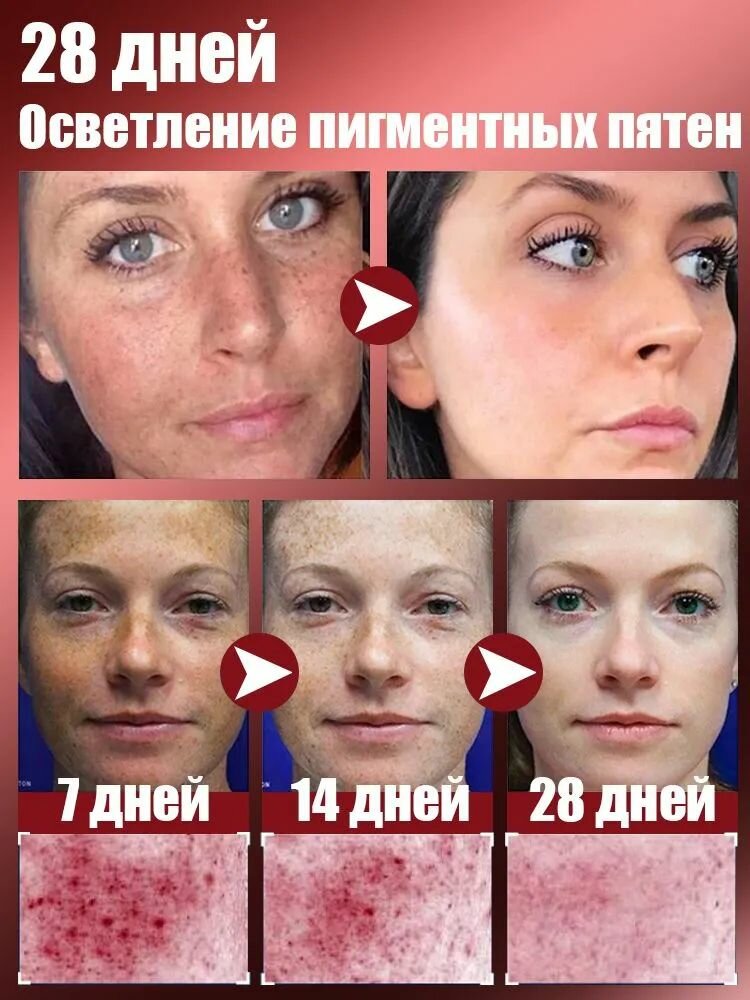 Крем для лица от Веснушек и Пигментных пятен 30г против пигментации, отбеливающий для лица увлажняющий, Содержит гиалуроновую кислоту и 377. увлажнение отбеливание гиалуроновая кислота 377
