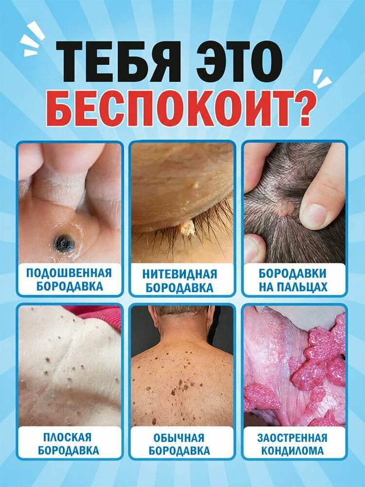 Безболезненное лазерное удаление бородавок, папиллом и родинок (подошвенных, плоских, генитальных, нитевидных) удаление папиллом удаление родинок
