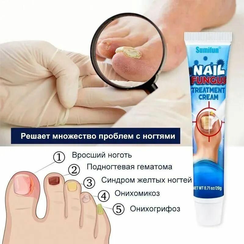 Средство от грибка ногтей на ногах, противогрибковые капли, уход за ногтями