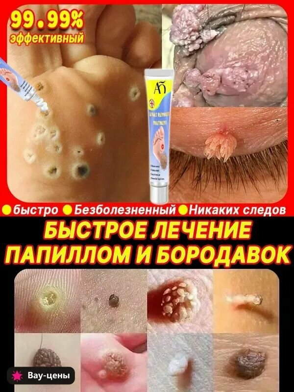 Гель-средство от папиллом, лечение бородавок, удаление родинок, крем от угревой сыпи, безболезненный, не оставляет следов, кожа становится гладкой и увлажненной, 1 шт