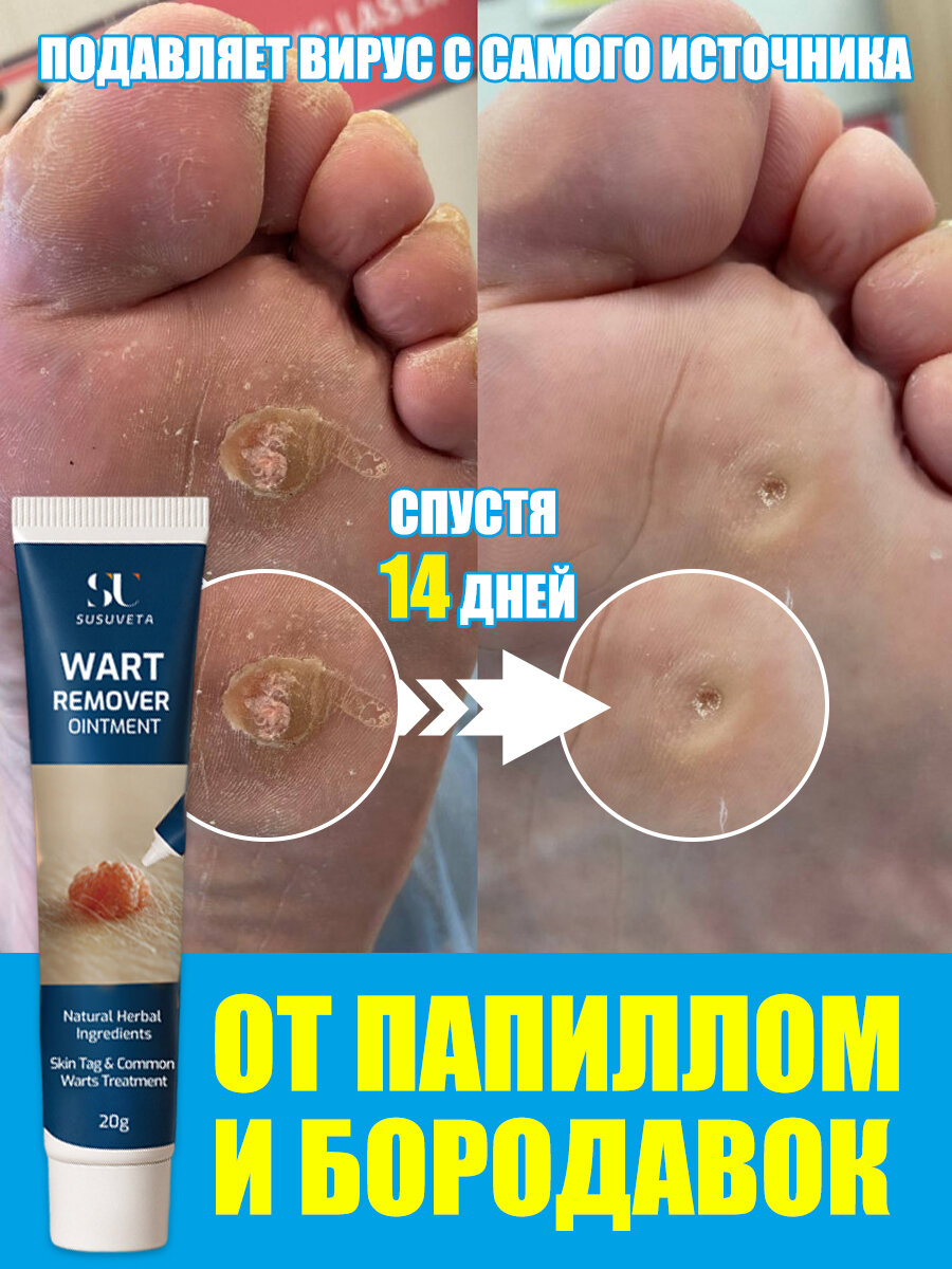 От папиллом и бородавок — Подавляет вирус с самого источника