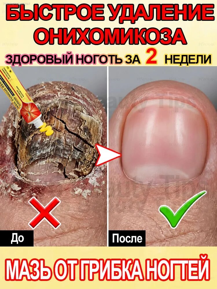 Противогрибковая мазь для ногтей, эффективное средство от грибка стопы и онихомикоза, уничтожает грибок, восстанавливает ногтевую пластинулечит зуд и шелушение, 90 мл