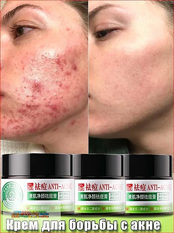 Крем от прыщей точечный, от прыщей и воспалений, постакне, для подростков и взрослых 30 г