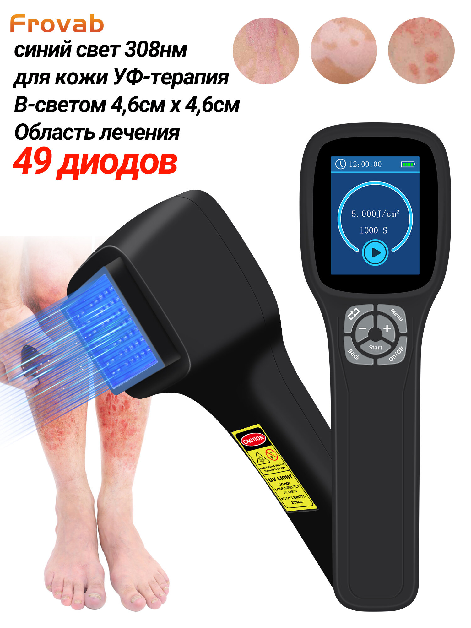 Аппарат УФ Frovab 308нм 49 диода, регулировка дозы, лечение витилиго, псориаза и кожных воспалений дома