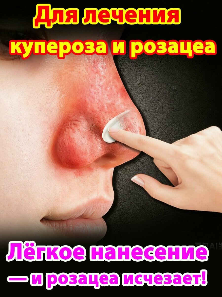 Быстрое лечение розацеа купероза и покраснений 30 г