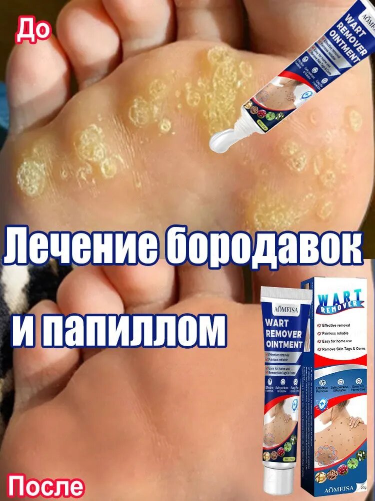 Мазь от бородавок, Крем средство для удаления бородавок, папиллом и родинок, безболезненно, не оставляет следов без побочных эффектов .200г.