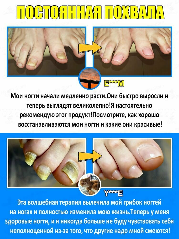 Лазерная ручка для лечения онихомикоза может устранить стойкий онихомикоз за 7 дней, улучшить состояние при паронихии, а также вылечить утолщение ногтей, покраснение, отек, зуд, расслоение и т. д.