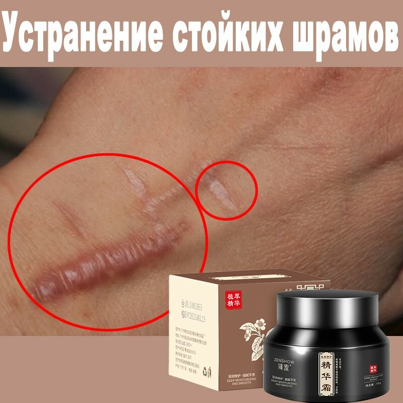 Крем для удаления рубцов, 50 грамм, подходит для удаления растяжек, шрамов от ожогов и пигментации, выравнивание рельефа и восстановление кожи.