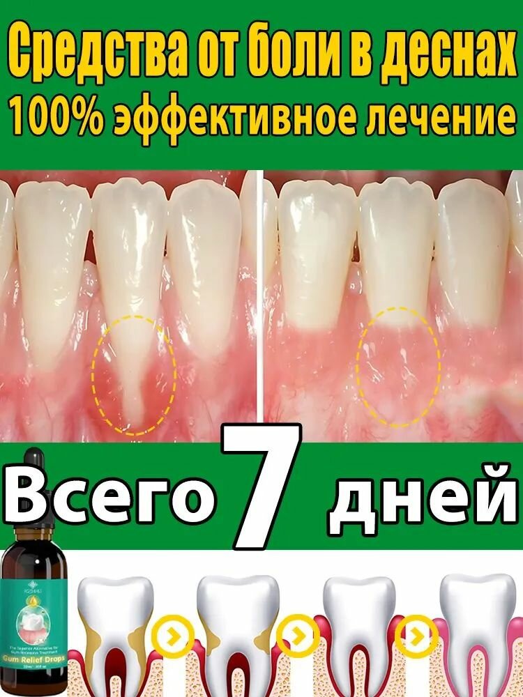 Используется для лечения пародонтита, стоматита, снятия чувствительности и отека десен, восстановления, профилактики и укрепления поврежденных десен, Гигиена полости рта, 30 мл, 1 флакон