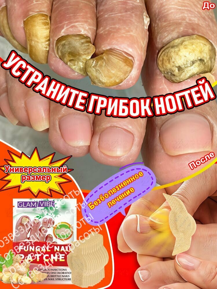Грибковые пластыри при онихомикозе обеспечивают быстрое лечение онихомикоза на руках и ногах, ухаживают за ногтями, снимают зуд, улучшают паронихий и не вызывают раздражения.21 таблетка