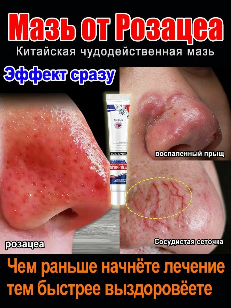 Мазь для лечения розацеа и покраснений на лице, средство от розацеа, Китайская чудо-мазь, 20 г