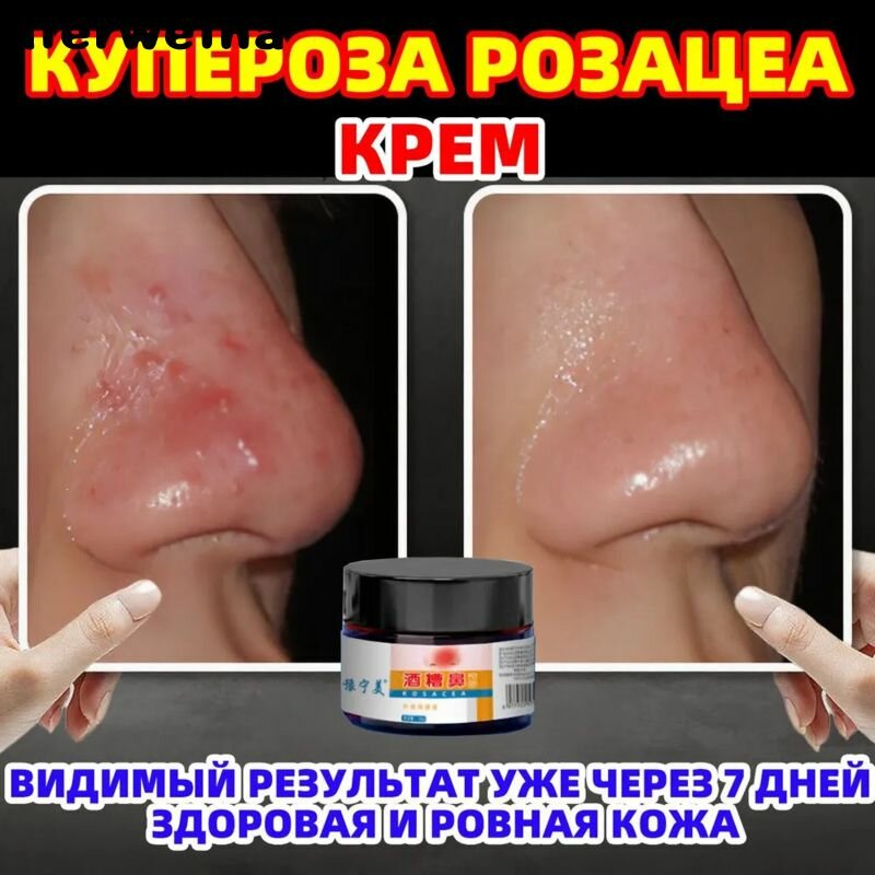 Крем от розацеа 30 г