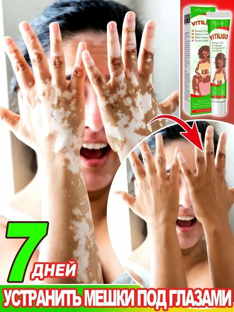 Мазь для лечения витилиго, эффективно удаляет белые пятна и регулирует пигментацию, выравнивает тон кожи и устраняет странные взгляды окружающих, 20 грамм